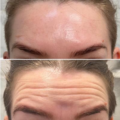 Redensity 1 Skin Booster - The Wellness Space Medispa Ltd
